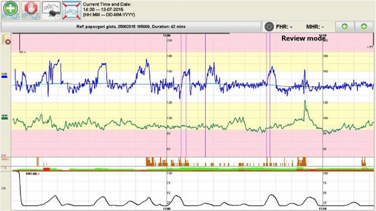 Dormed Hellas – Monica AN24 - Fetal Monitor Portable